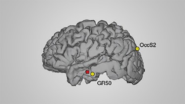 BrainGate - Turning Thought Into Action